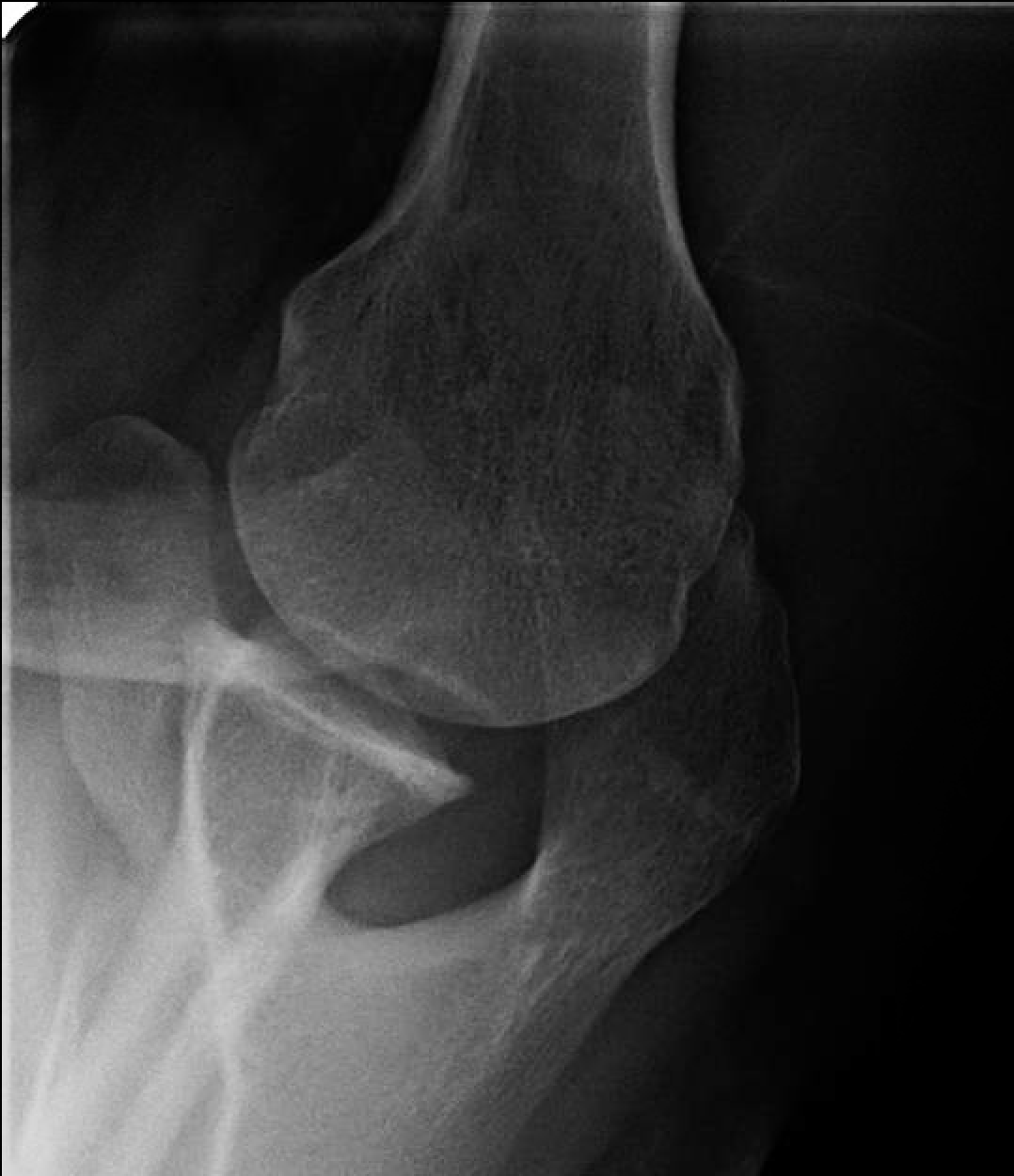 UW Shoulder and Elbow Academy: Avascular necrosis in a patient under 40 ...
