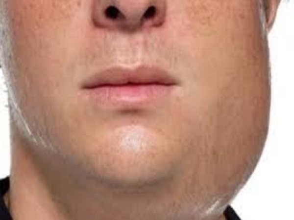 Doença Da Parótida - Infecção Provocada Por Vírus - Saúde & Conhecimento