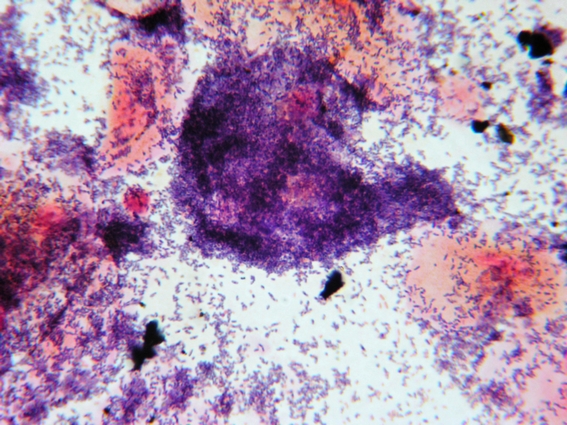 Fun With Microbiology (What's Buggin' You?): Bacterial Vaginosis