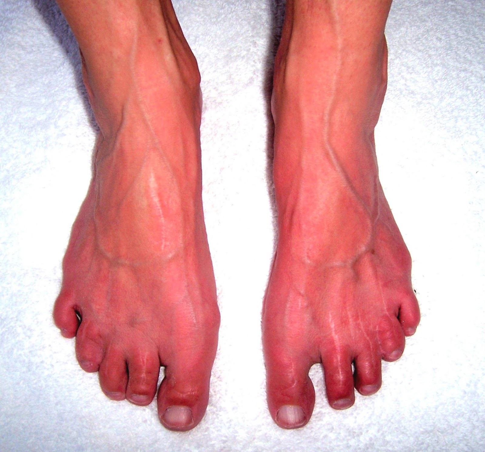 Burning Feet Erythromelalgia at Nathan Mcnicholas blog
