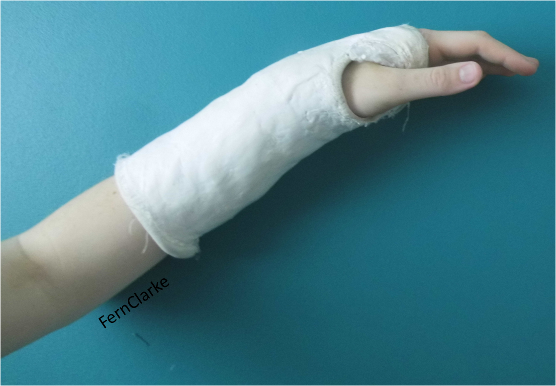 Forever Fern: CAST HACKS - I BROKE MY WRIST