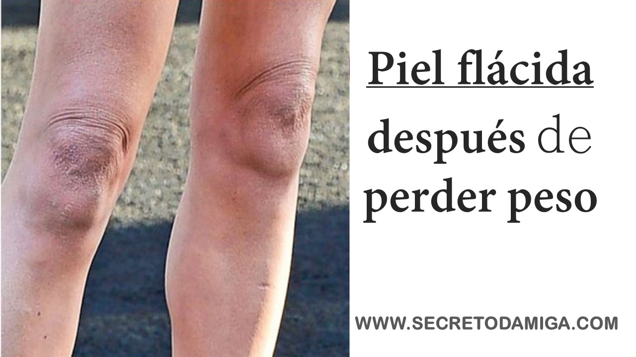 PIEL FLÁCIDA POR PÉRDIDA DE PESO - Secretodamiga