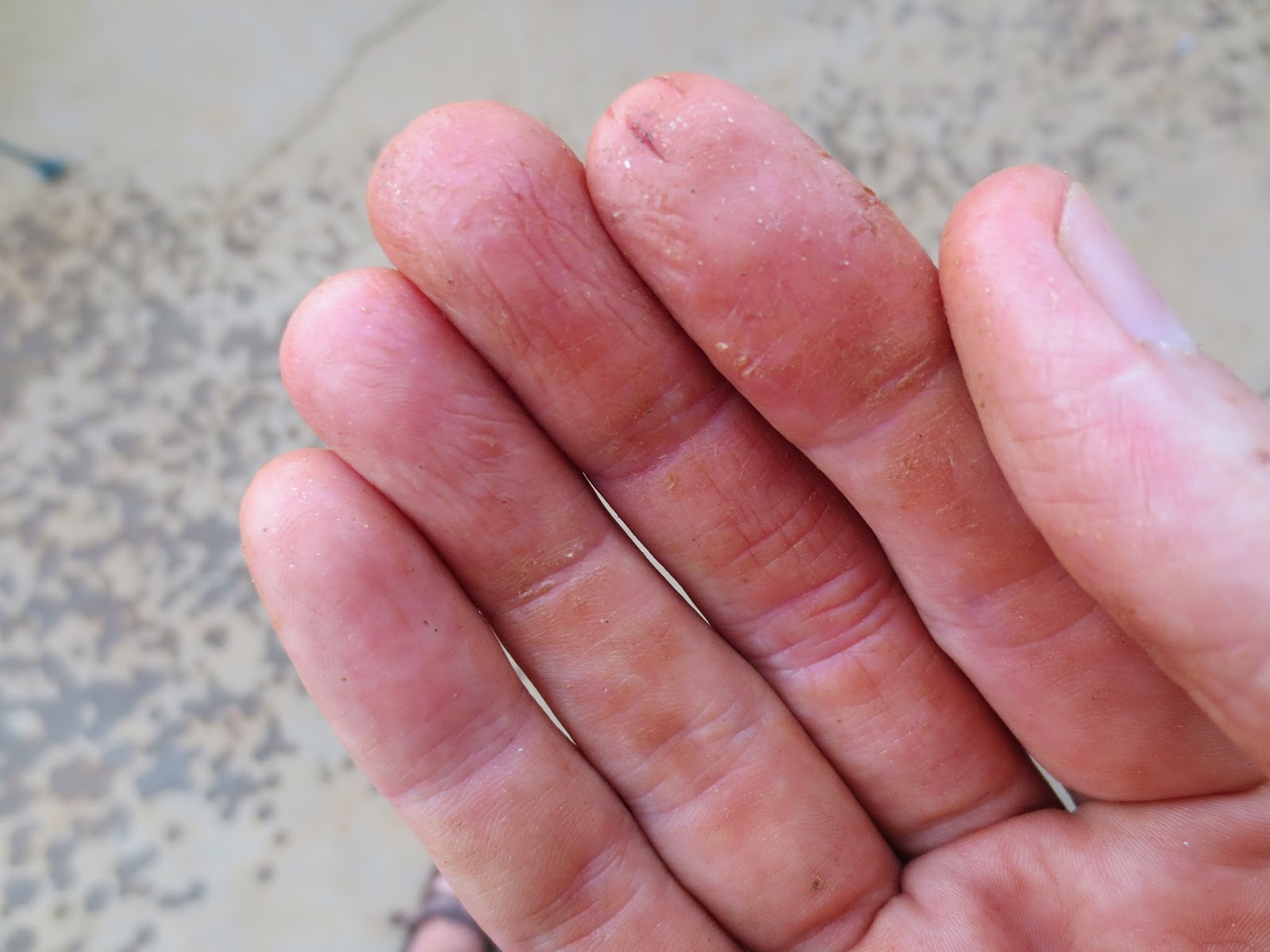 SKIN DISEASE TYPES: Vesicular Hand Dermatitis (Skin Disease type)