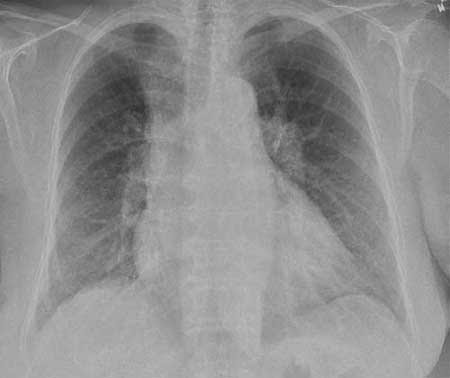 Acute Right Ventricular Failure Complicating Myocardial Infarction Case ...