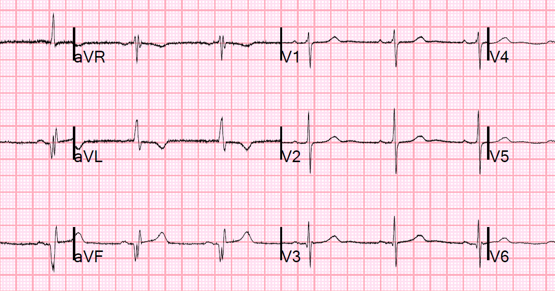 Dr. Smith's ECG Blog: Coronary Disease and Chest pain: Is it acute ...
