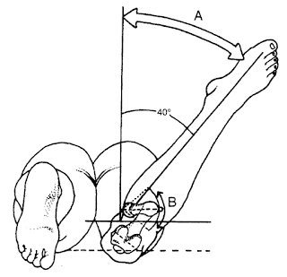 Craig Test | Hip Anteversion / Retroversion - Bhaskar Health ...
