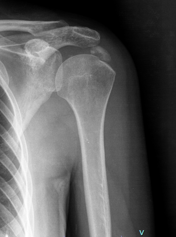 Traumatólogo de Guardia - Pedro Larrauri - Vigo.: ¿Puede desaparecer ...