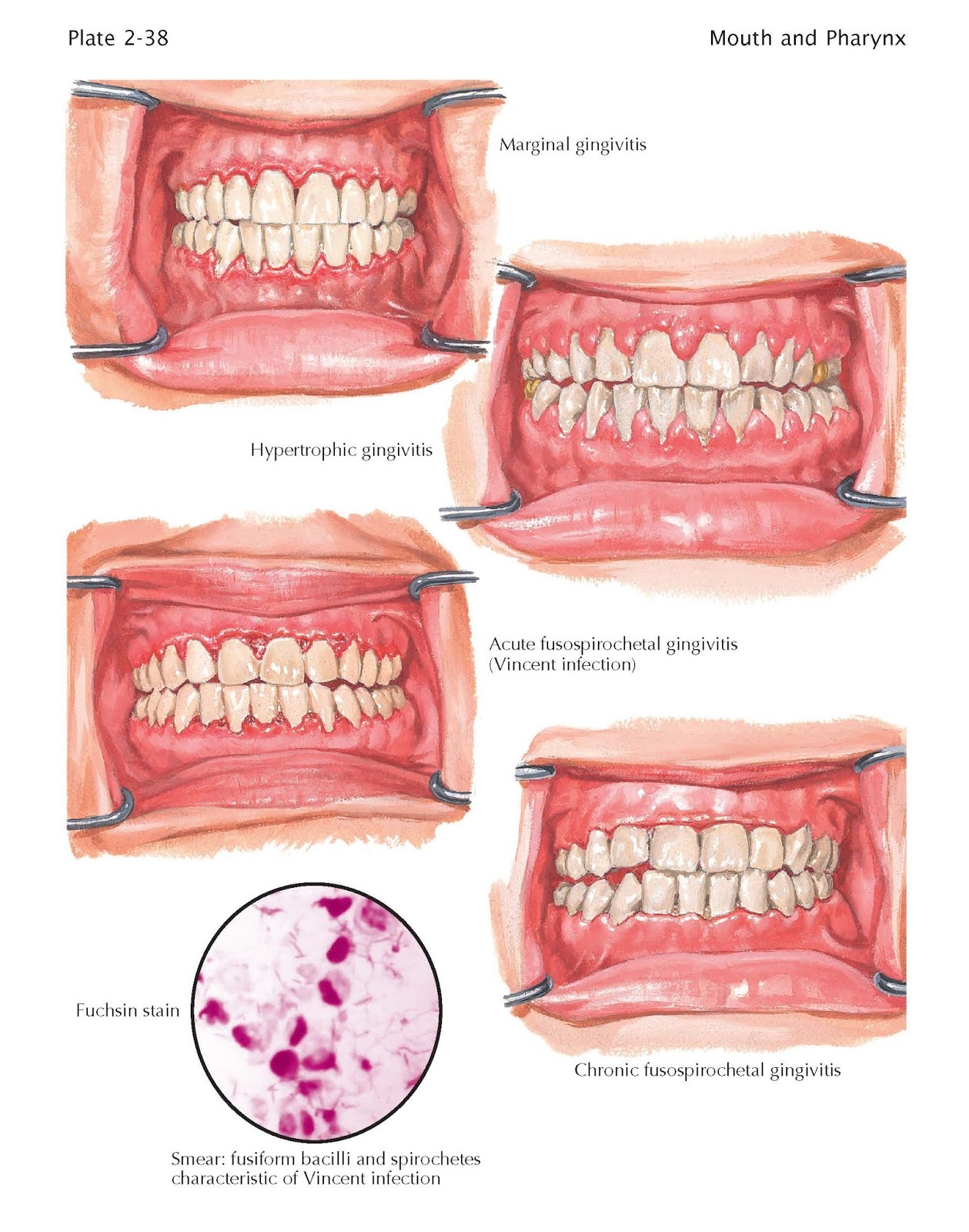 Gingivitis - pediagenosis