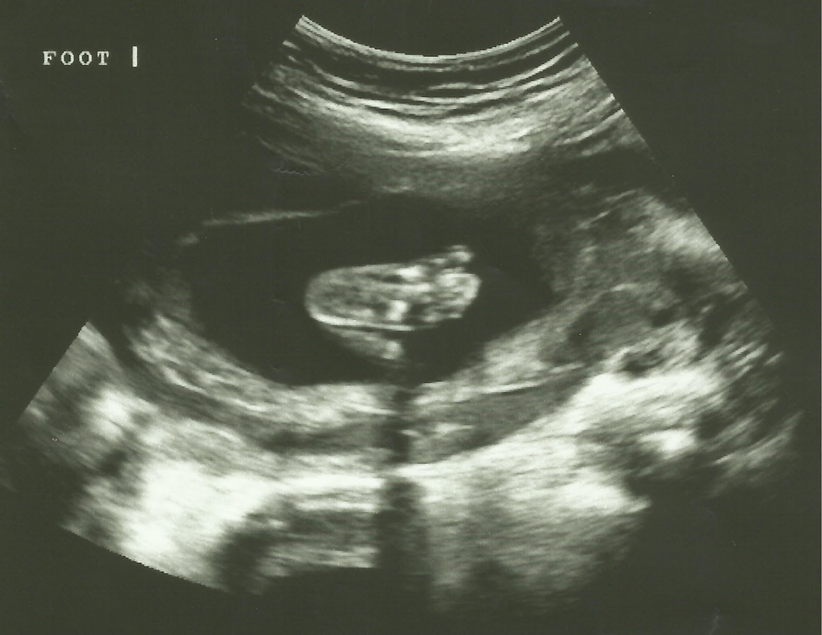 Discovering Your Own Stream ♥: 20 Week Ultrasound - Anatomy Scan