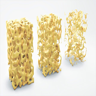 Osteoporose (botontkalking) natuurlijk behandelen