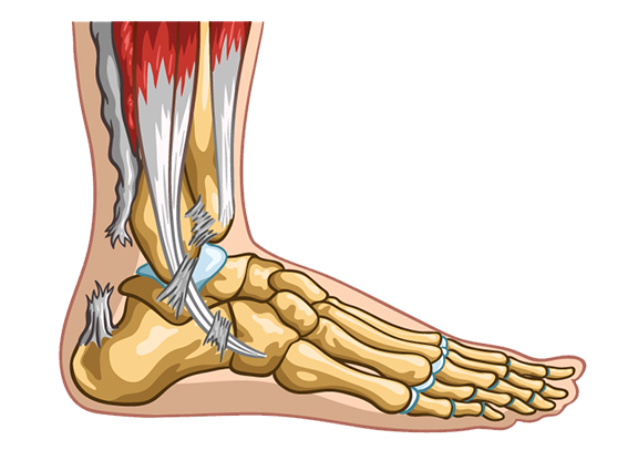 Tendão calcâneo - lesão no esporte