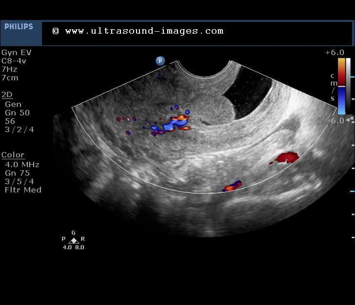cochinblogs: Sonography in the case of pedunculated polyp
