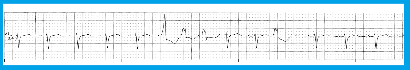 Practice Rhythm Strips 255