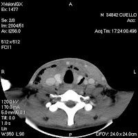 Cirugía de Cabeza y Cuello Rosario: Angina de Ludwig