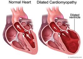 Types of Cardiomyopathy: Different Types of Cardiomyopathy