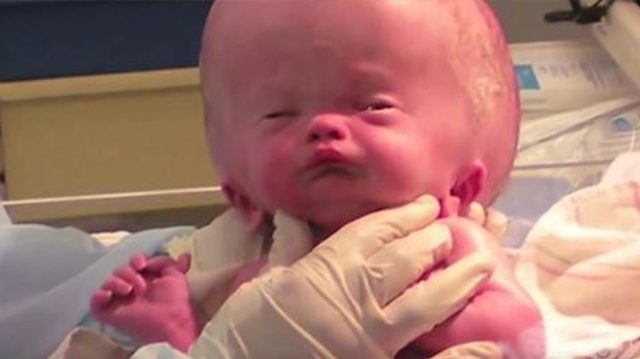 Baby’s brain occupies 5% of massively enlarged skull—after multiple ...