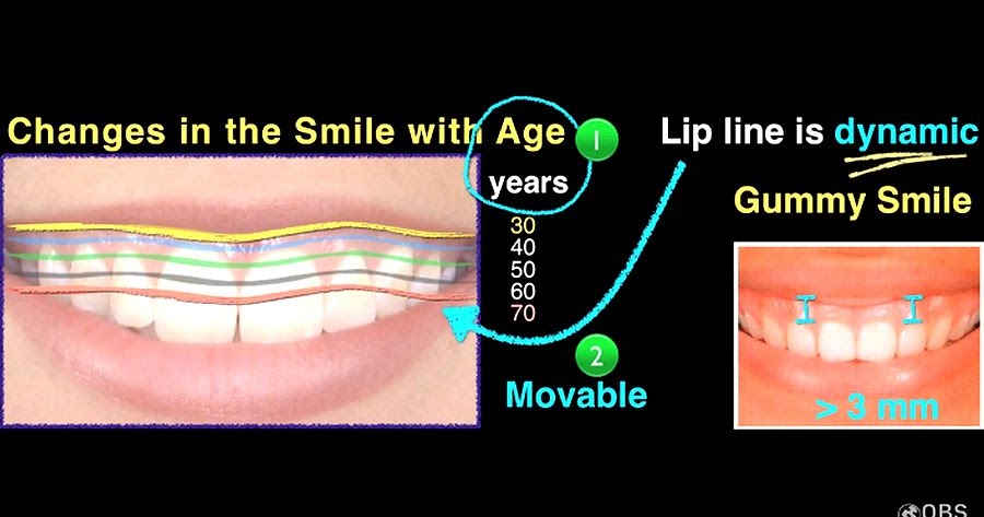 GUMMY SMILE Treatment - Clinical Case of Dr. Chris Chang - Odonto-Tv