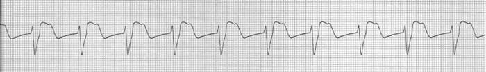 Anterior St Elevation Myocardial Infarction (STEMI) Case File