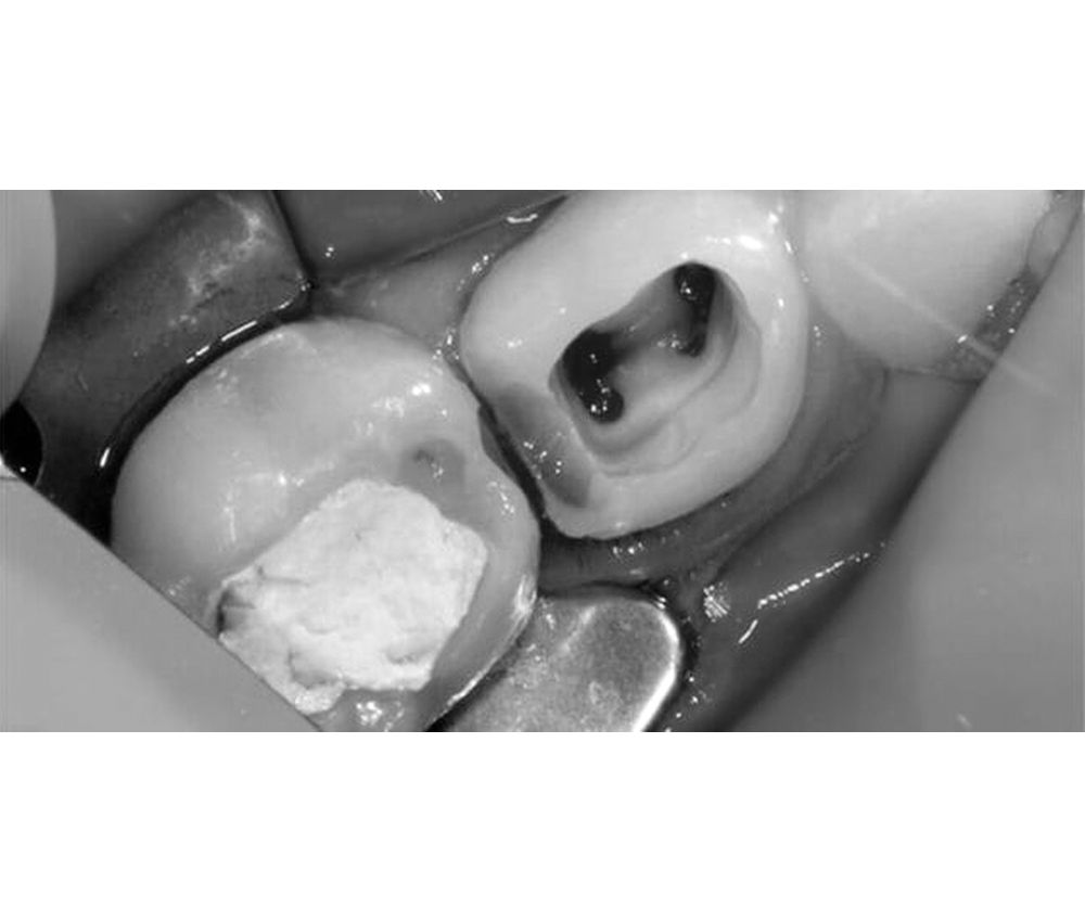 Pulpotomy of Deciduous Molar - Step by step - OdontoVida