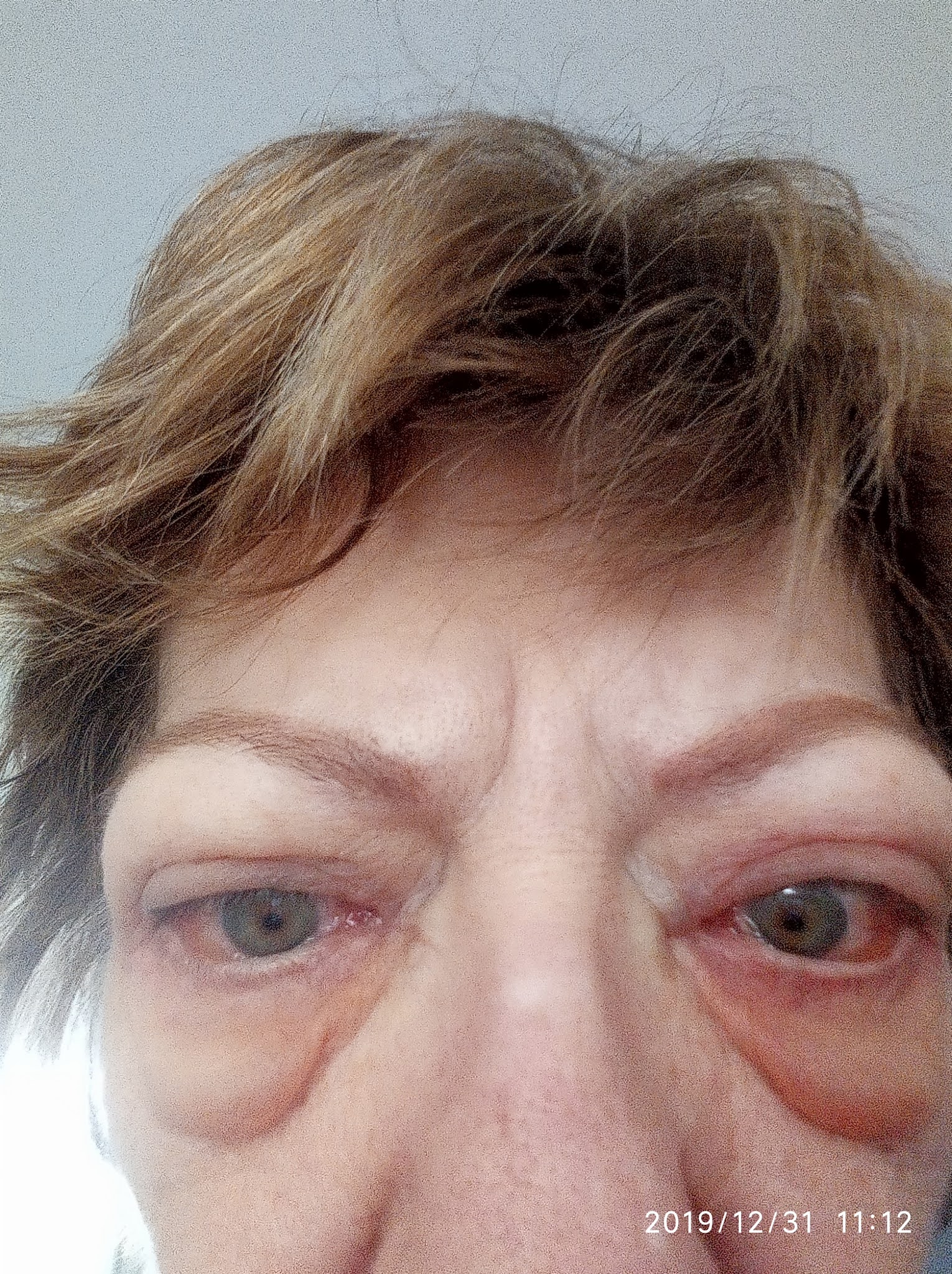 LA MALADIE DE BASEDOW