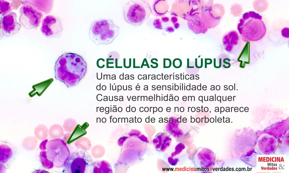 Aprendendo com o Lúpus : Tirem suas dúvidas: o que é Lúpus Eritematoso ...