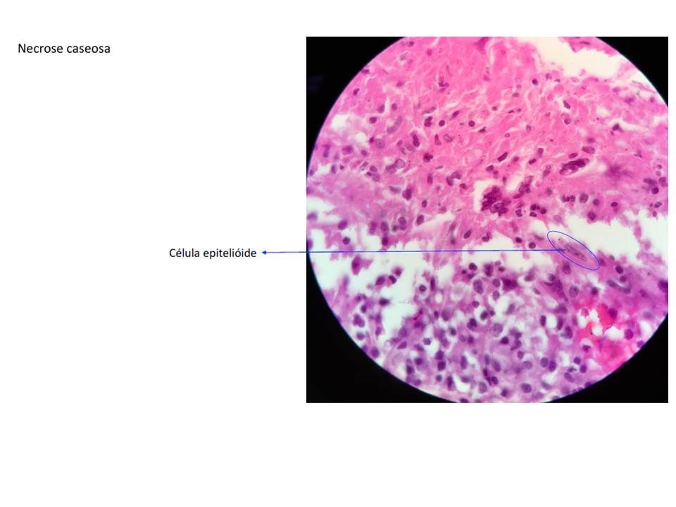 HISTOLOGIA90: TIPOS DE NECROSE