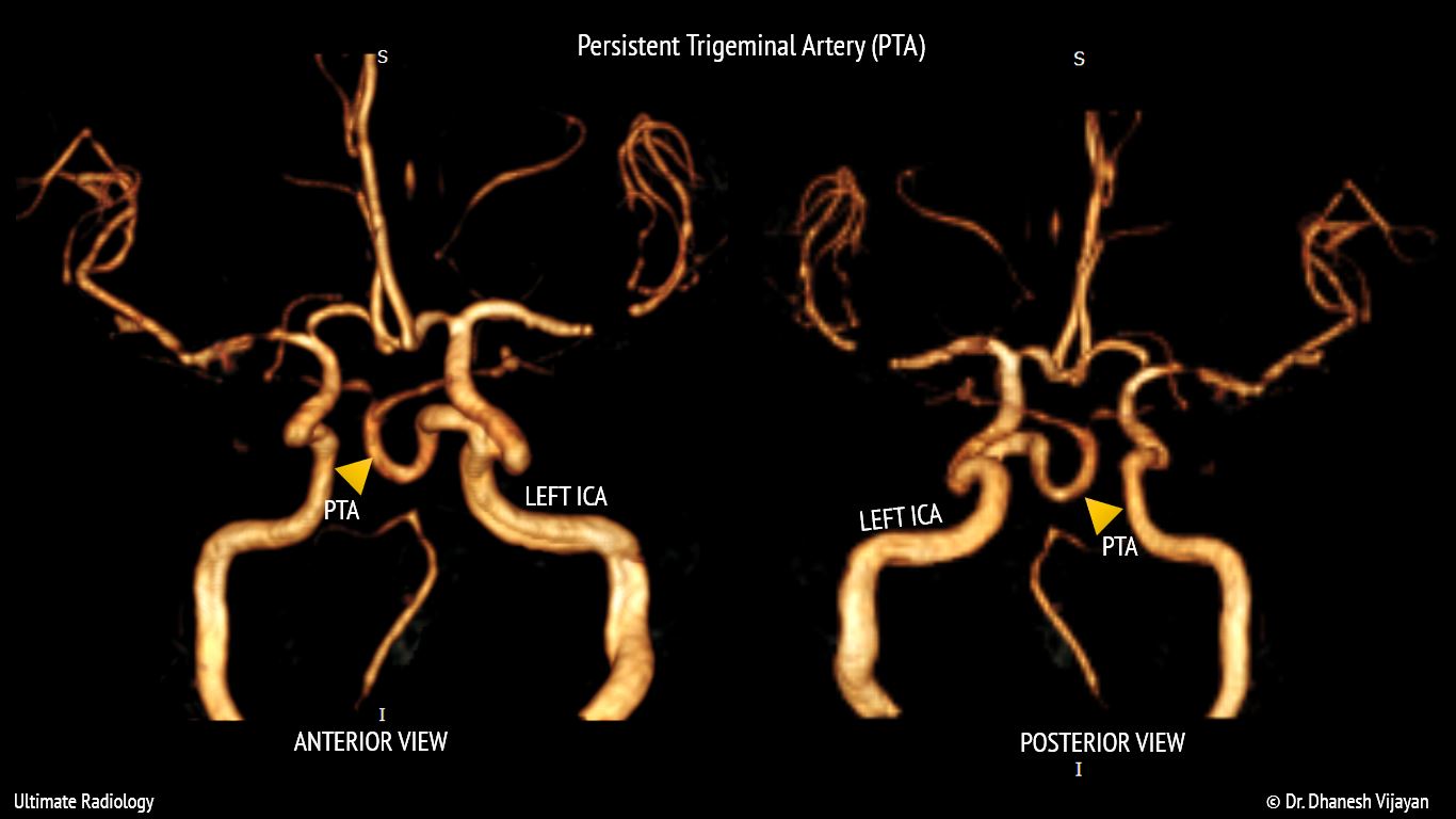 Ultimate Radiology : Persistent Trigeminal Artery (PTA), Tau sign