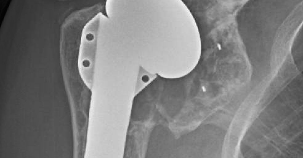 Shoulder Arthritis / Joint Replacement : Failed total shoulder revised ...