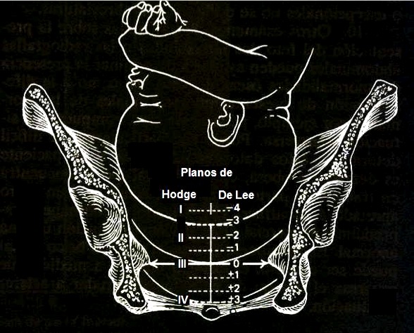 Ginecologia y Obstetricia: Planos de Hodge y De Lee