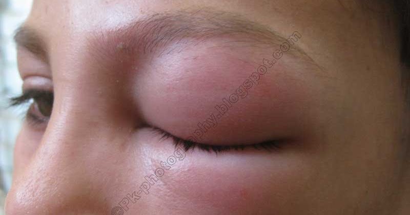 Wasp Sting Swollen Toe