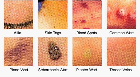 मस्सों का घरेलू उपचार (Home remedies for warts) | स्वस्थ जीवन: Healthy life