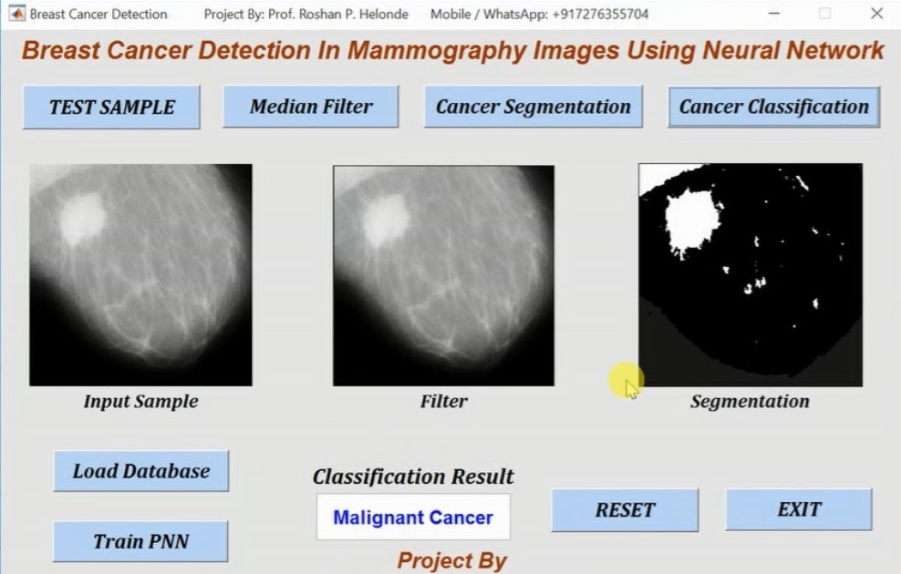 Breast Cancer Detection In Mammography Images Using Neural Network ...