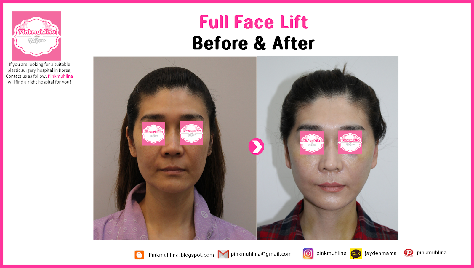 [Pinkmuhlina] Incisional Full Face Lfiting Surgery Before and After ...