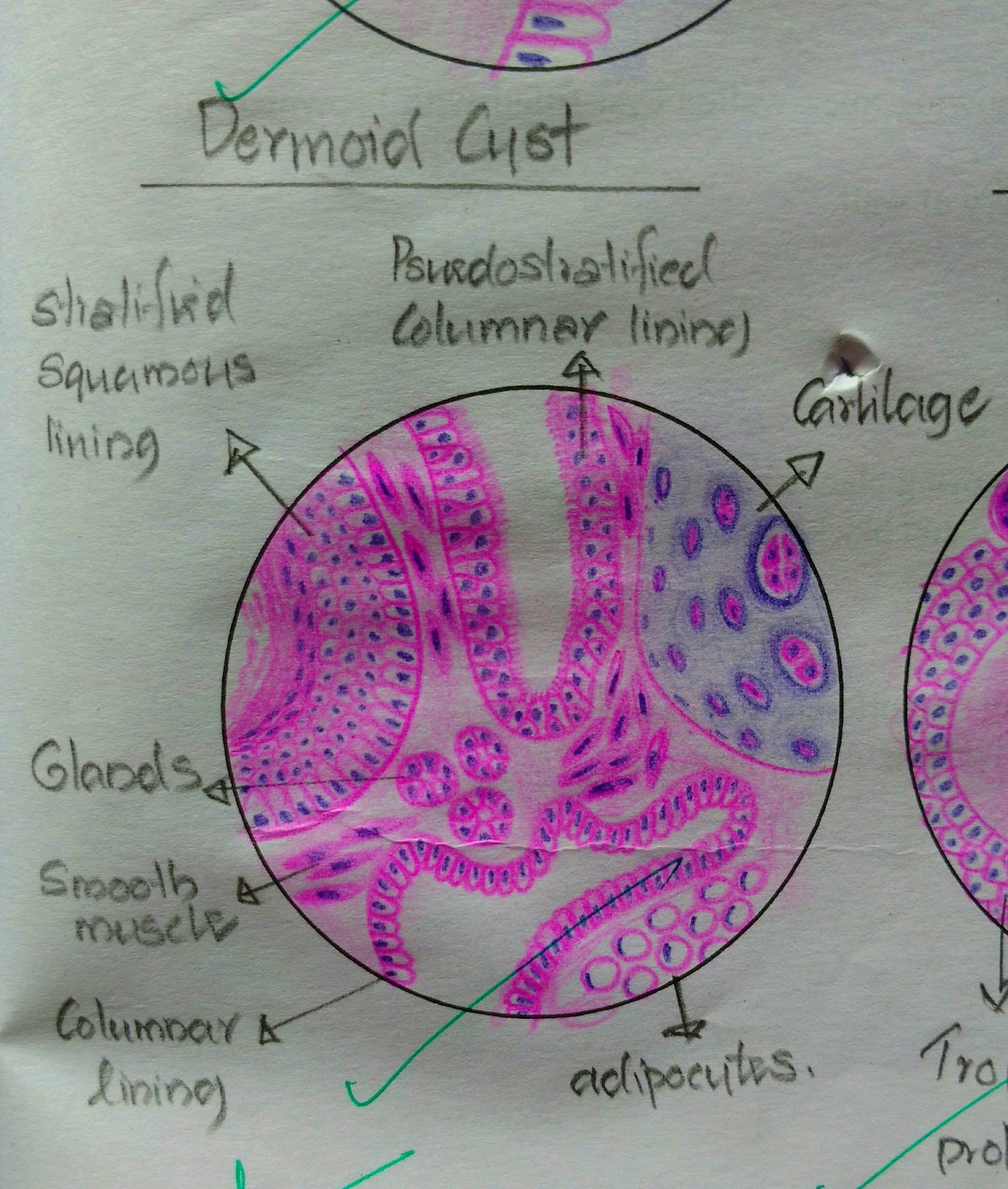 Histopathology Drawings: Dermoid Cyst