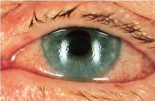 [Emergency] ATLAS OF ACUTE ANGLE-CLOSURE GLAUCOMA | Free Medical Atlas