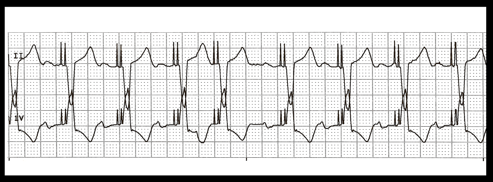Practice Rhythm Strips 257