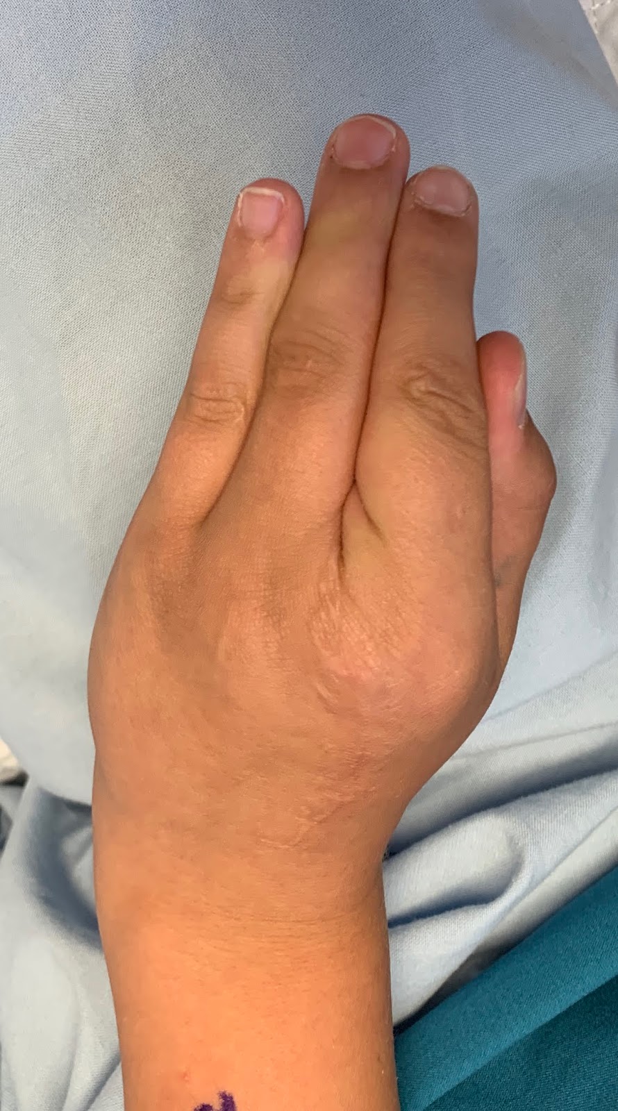 Cleft Hand: Beyond the Basics | Congenital Hand and Arm Differences ...