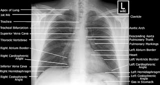 TEKNIK RADIOGRAFI THORAX - Radiografer
