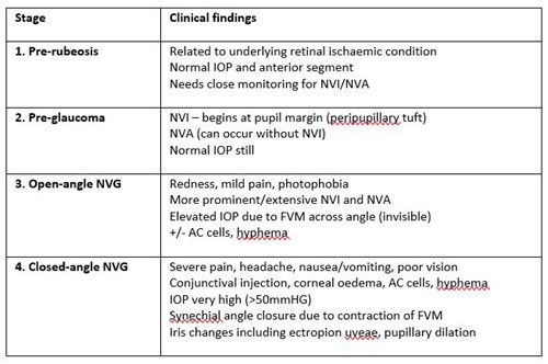 Ophthalmology Notes: Neovascular Glaucoma