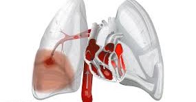 Embolia Pulmonar - Sintomas e causas - Artigos sobre saúde