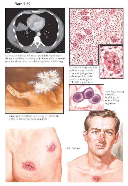 BLASTOMYCOSIS - pediagenosis