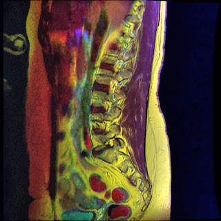 Nevit's blog: Color MRI of the Lumbar vertebrae