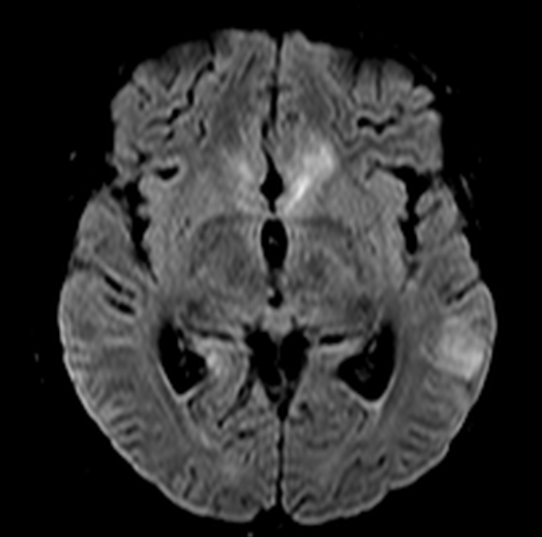 Paralisis de la mirada conjugada