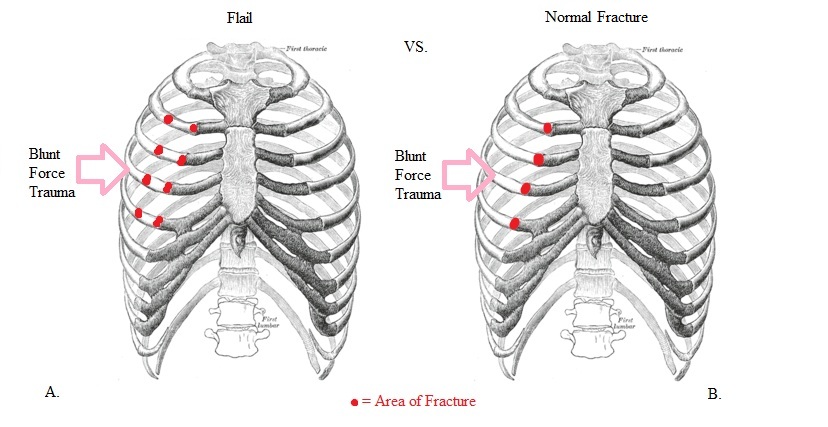 Flail Chest Diagram