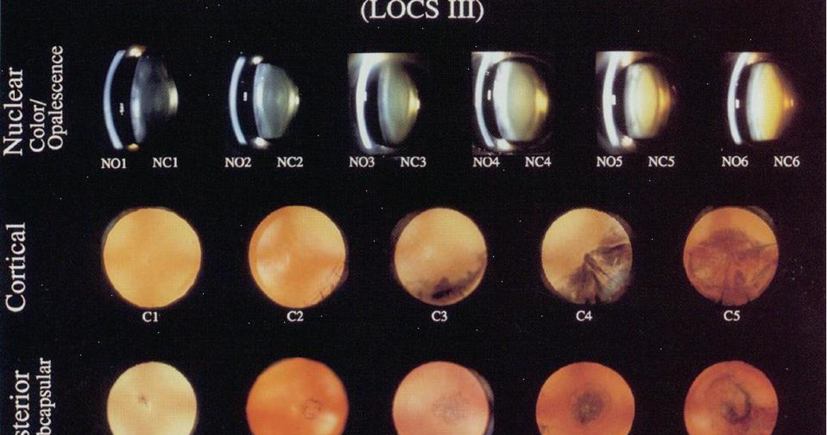 Ophthalmology Notes: LOCS III Cataract grading system