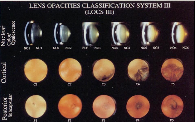 Ophthalmology Notes: LOCS III Cataract grading system