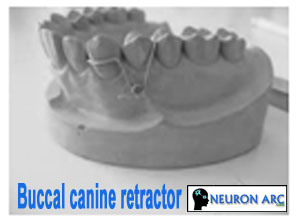 hiphoplife: Buccal canine retractor