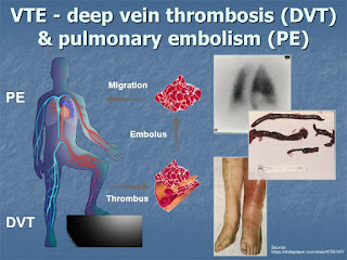 charmedkath: Venous Thromboembolism (VTE) Risk during Stay-at-Home