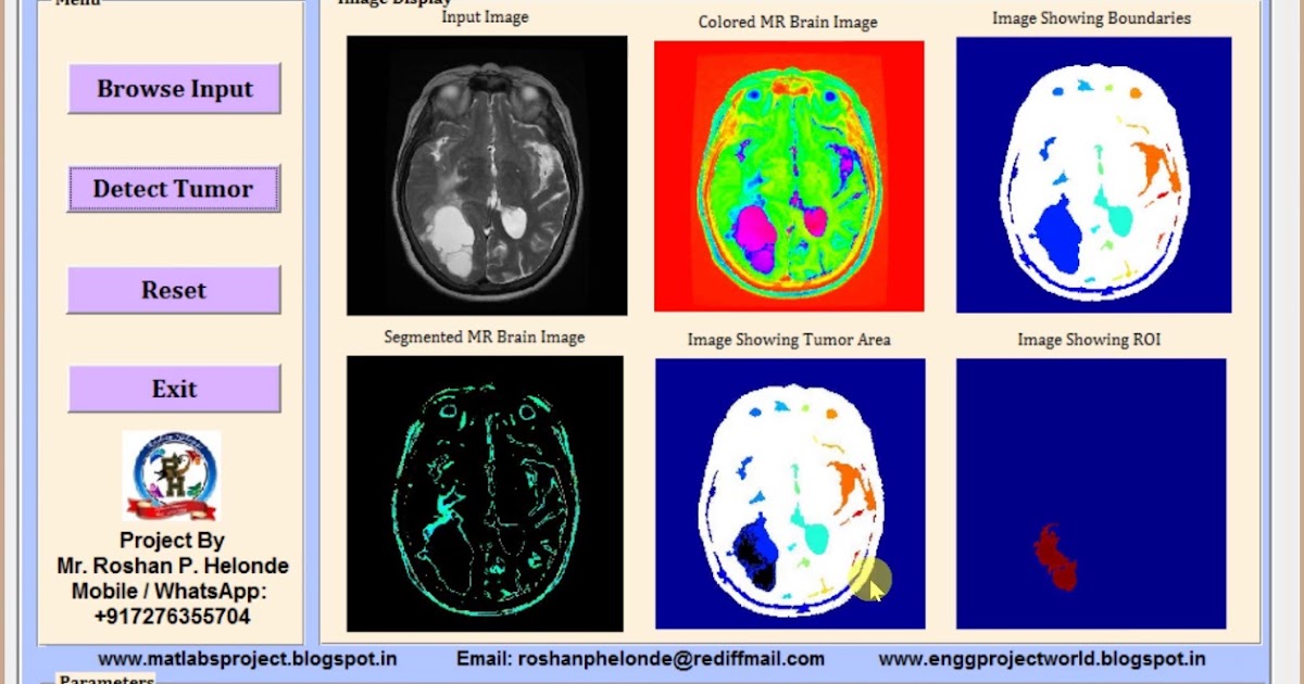 Brain Tumor Detection and Tumor Stage Classification using Image Processing Matlab Source Code ...