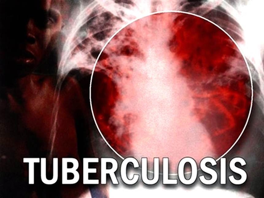 Tuberculosis Causes Symptoms And Factors That Could Put You At Risk Tuberculosis Causes Symptoms And Factors That Could Put You At Risk